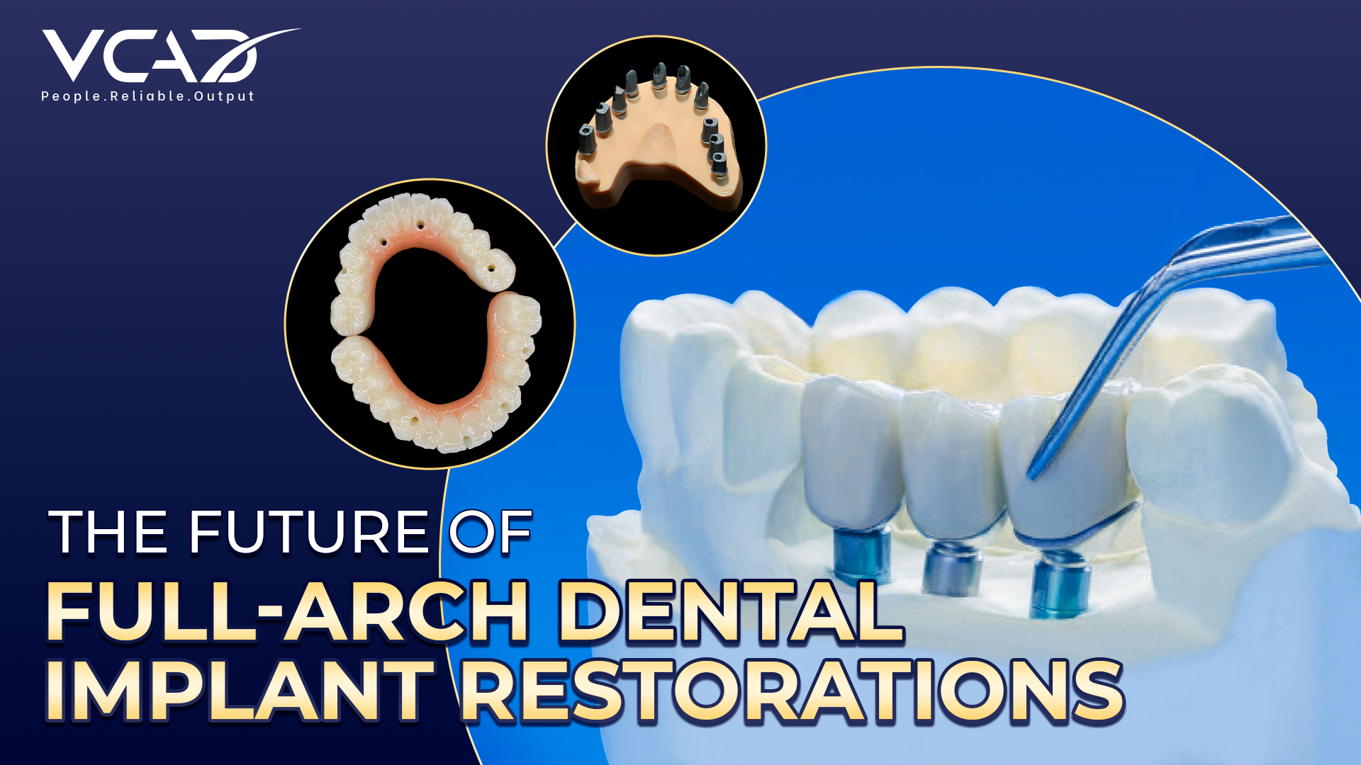 The Future of Full-Arch Dental Implant Restorations - VCAD